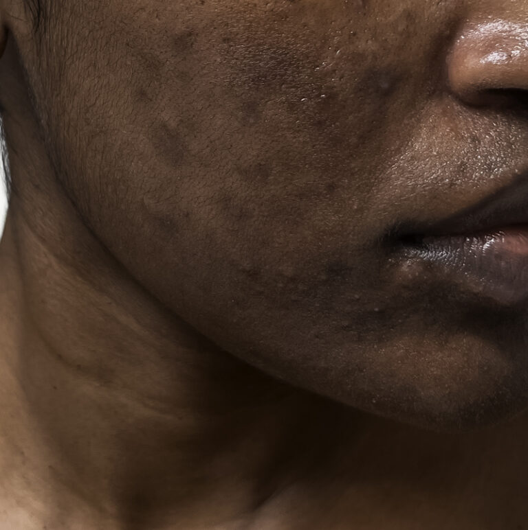 Skin Care Solutions: How to Treat Post-Inflammatory Hyperpigmentation