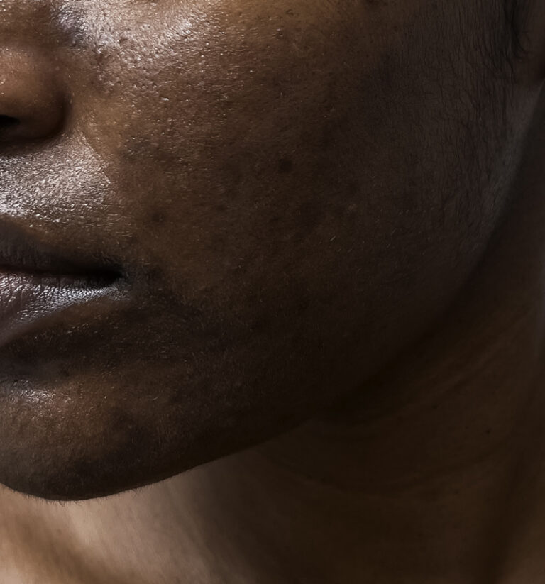 Skin Care Solutions: How to Treat Post-Inflammatory Hyperpigmentation